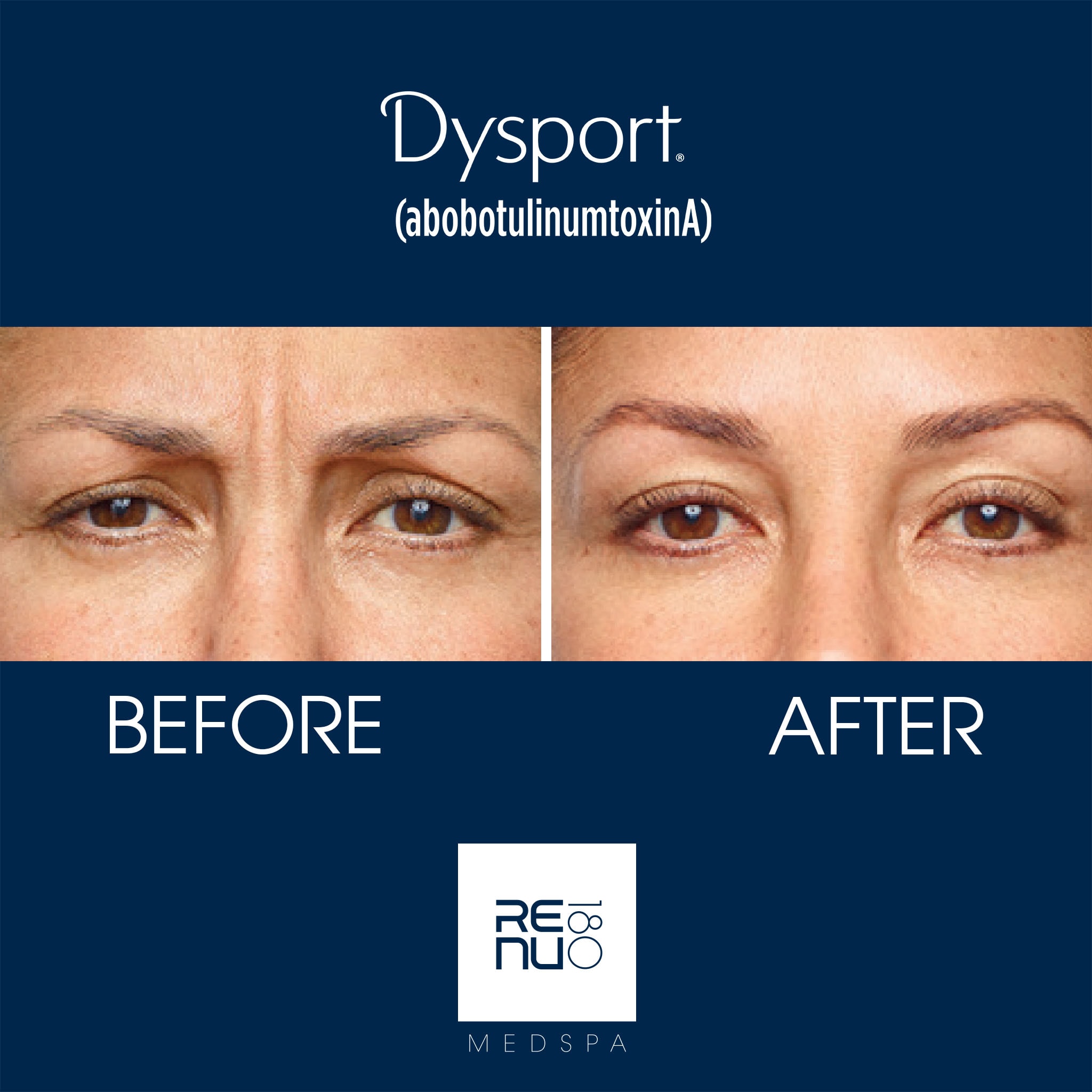 Botox vs. Dysport | What's the Difference | Re:nu 180 Medspa CT