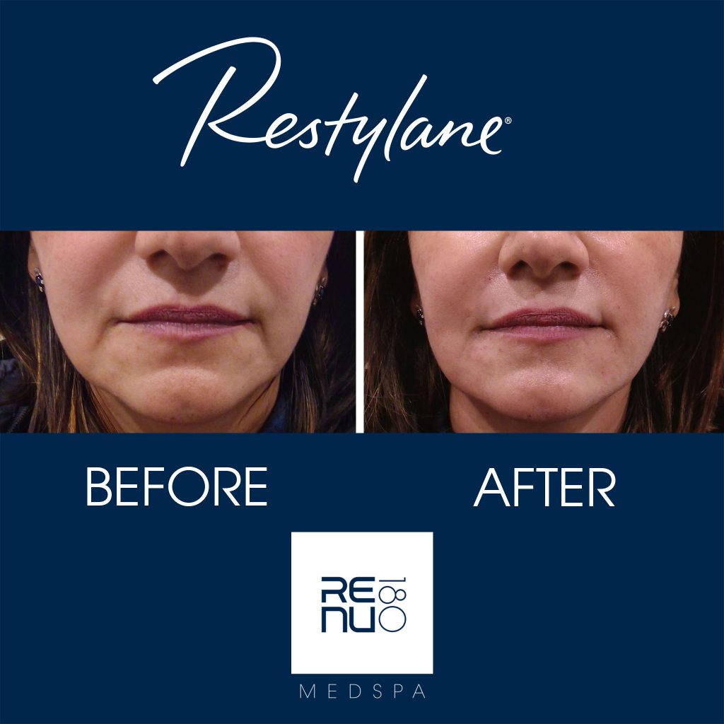Restylane Defyne Facial Filler | Re:nu 180 Medspa