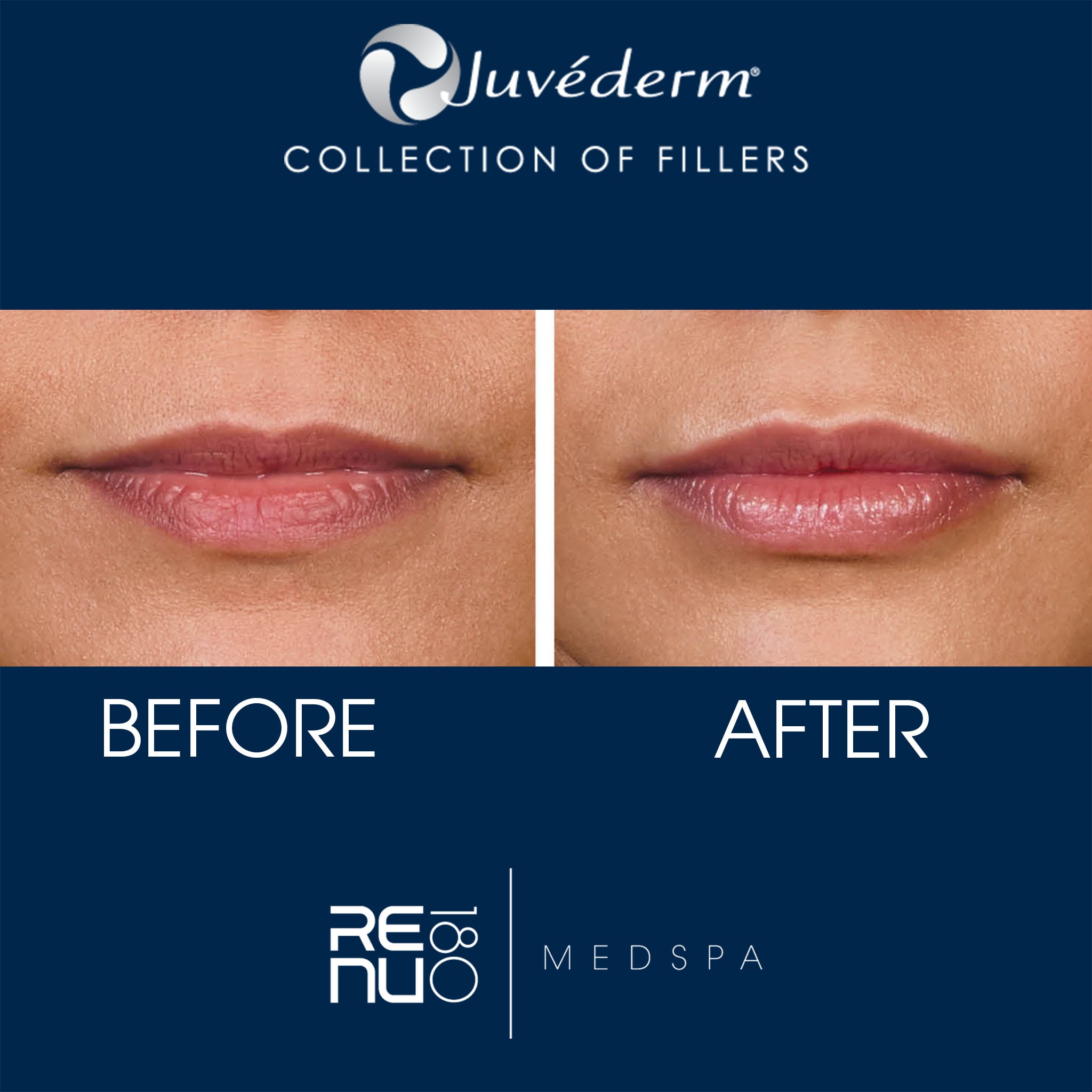 Juvéderm CT | #1 Dermal Fillers in Connecticut | Re:nu 180
