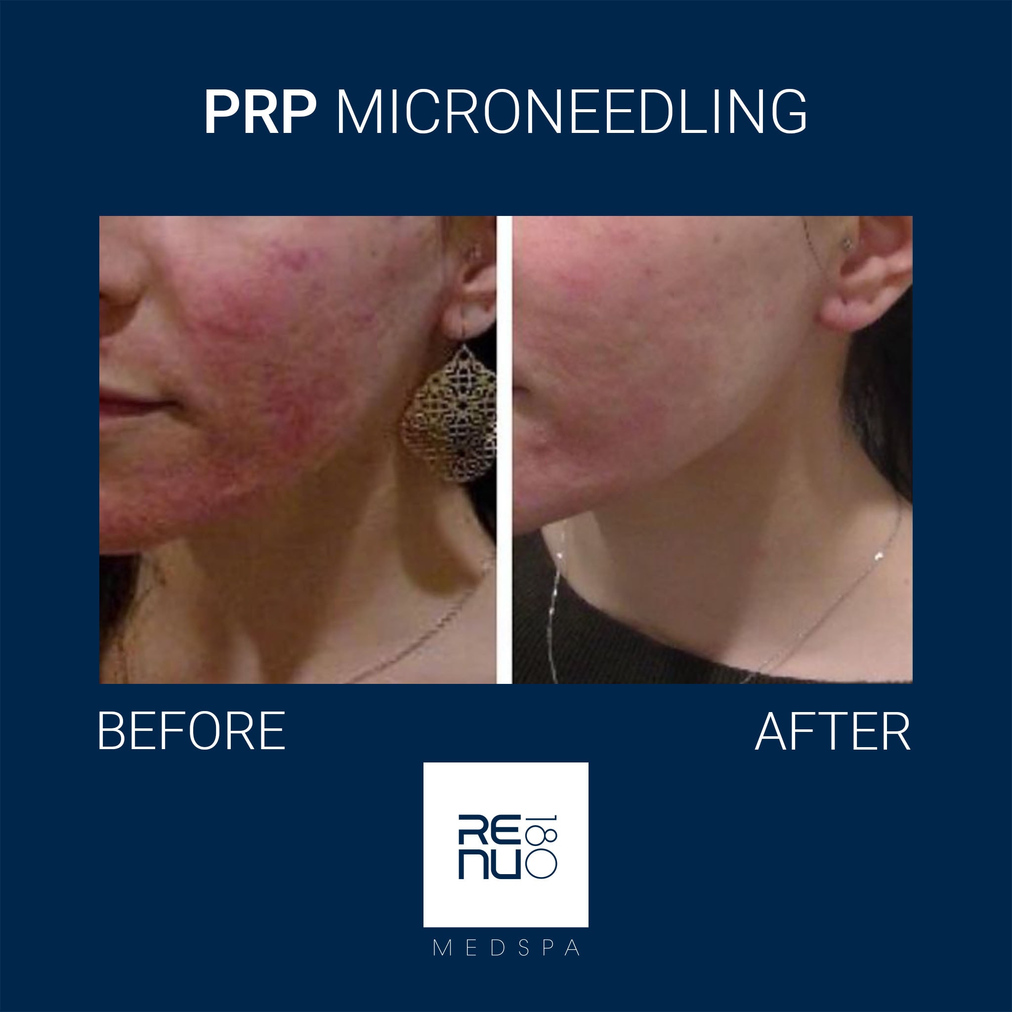 Before and After Gallery - PRP Microneedling | Re:nu 180 Medspa