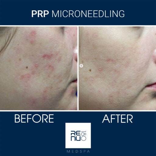 Before and After Gallery - PRP Microneedling | Re:nu 180 Medspa