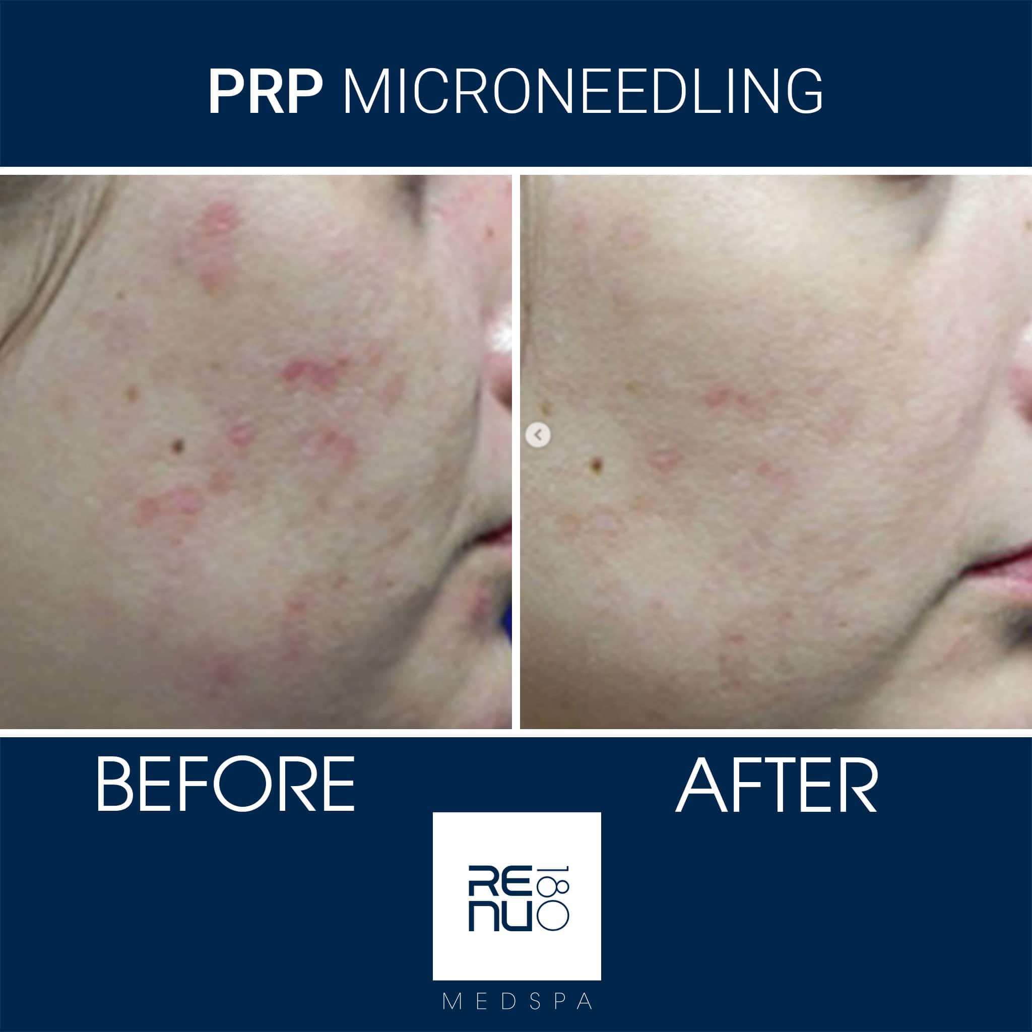 Before and After Gallery - PRP Microneedling | Re:nu 180 Medspa