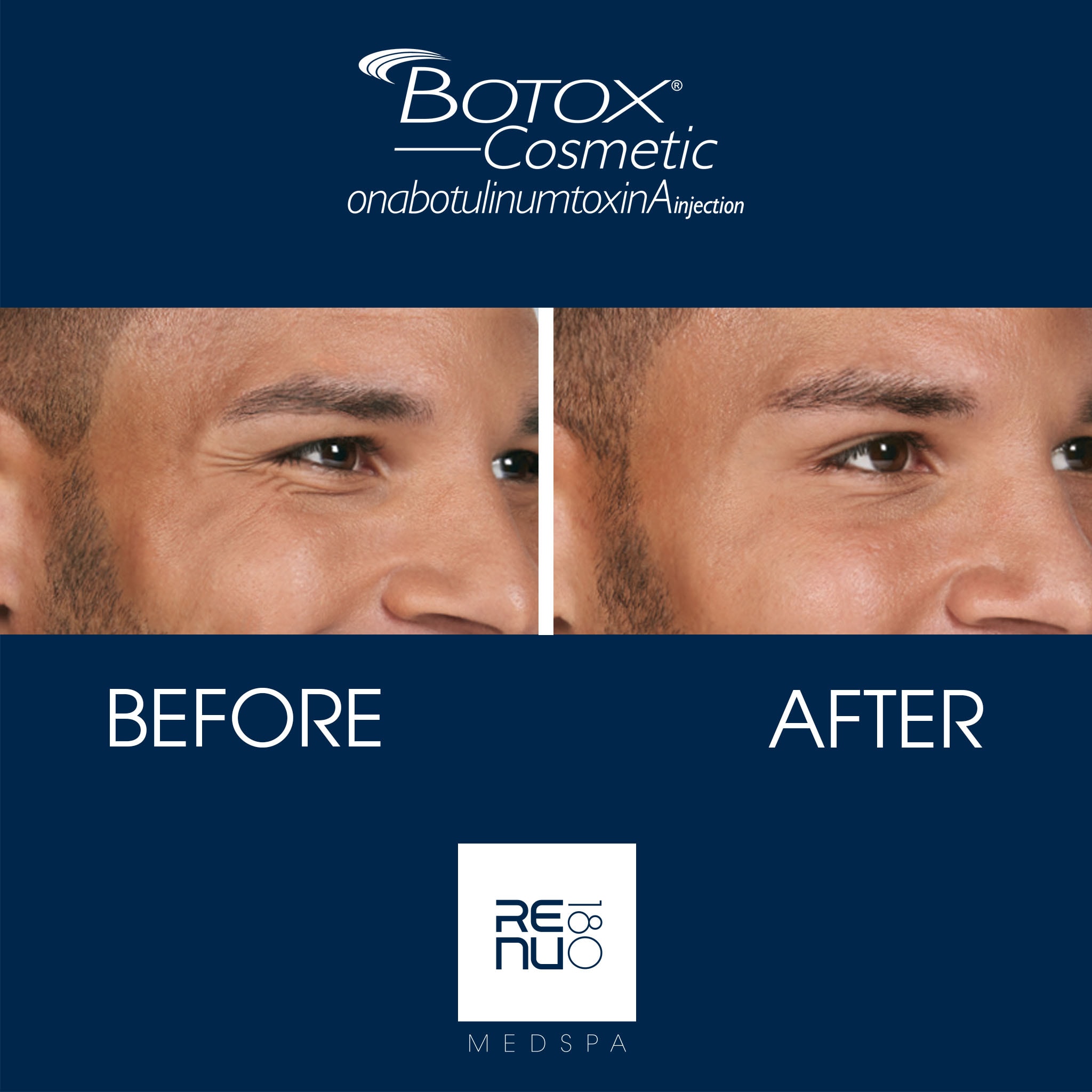 How Much Does Botox Cost? | Re:nu 180 Medspa