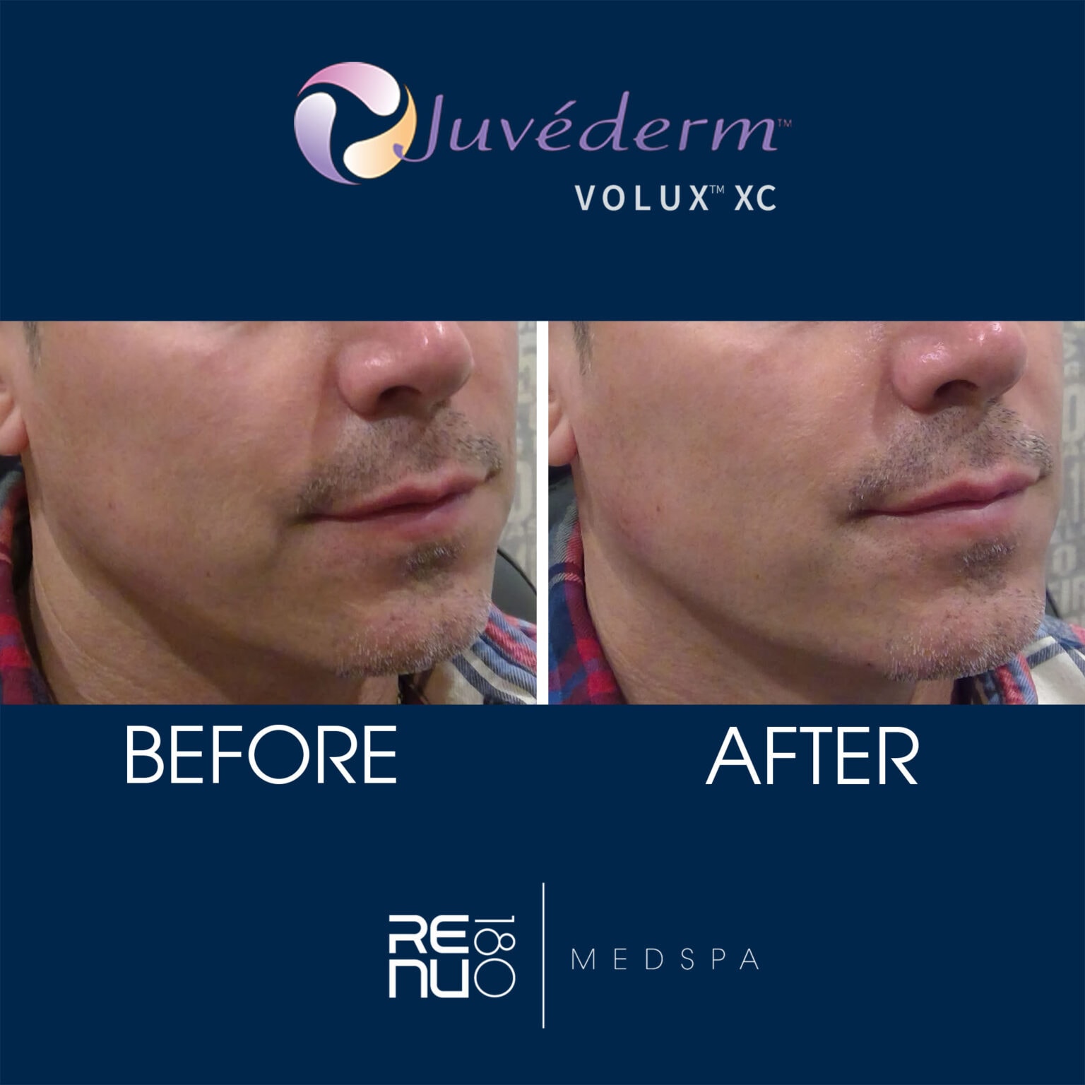 Restore Your Jawline | Juvéderm® Volux™ XC | Re:nu 180 Medspa