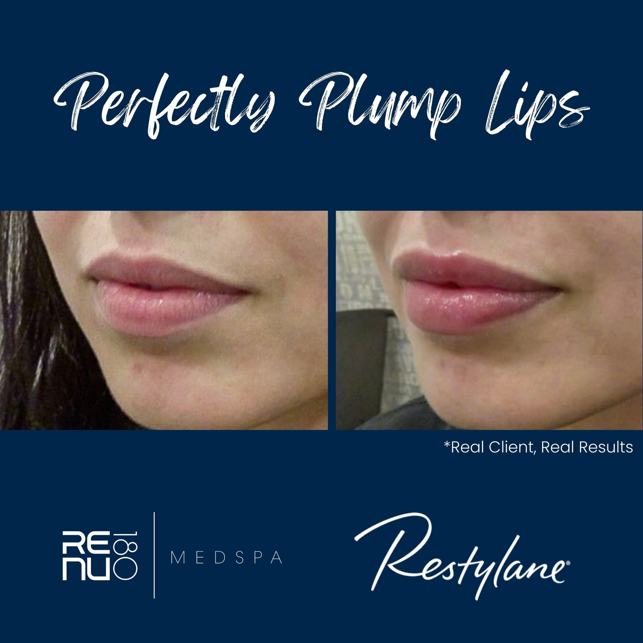Restylane CT | #1 Dermal Fillers in Connecticut | Re:nu 180